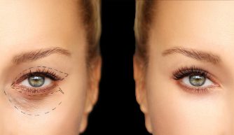 Profound à Paris : Lifting médical du visage | Dr Kevin HADDAD